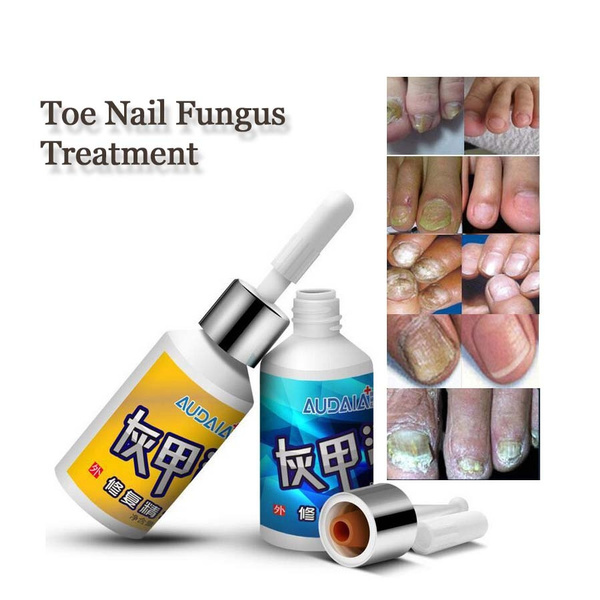 Fungal Nail Treatment Onychomycosis Paronychia Anti Fungal Nail ...