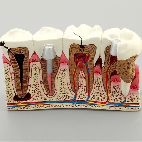 Dental Anatomy of dental caries plastic teeth model demonstration ...