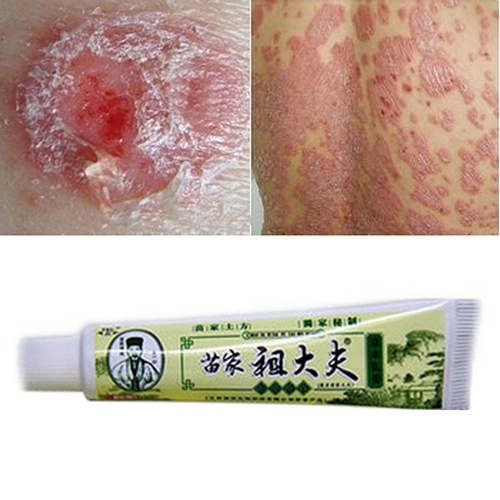 High Quality Chinese Herbal Psoriasis Dermatitis Eczema Pruritus ...