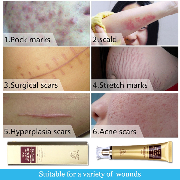 Hot Sale 30g Skin Body Repair Cream Stretch Marks And Scar Removal ...