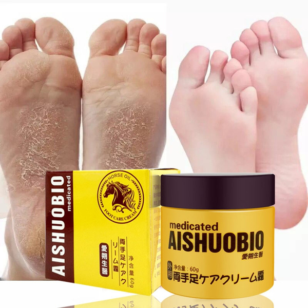 Treat Dermatophytosis, Athlete's Foot and Feet Tickle Skin Care Cream ...