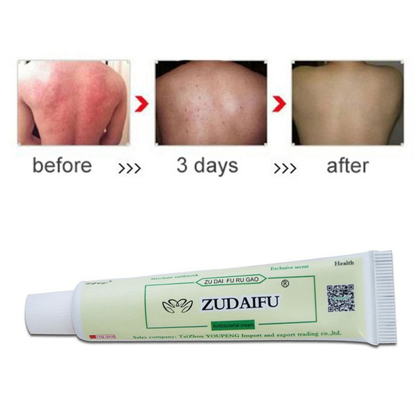 ZUDAIFU Body Psoriasis Dermatitis and Eczema Pruritus Ointment ...