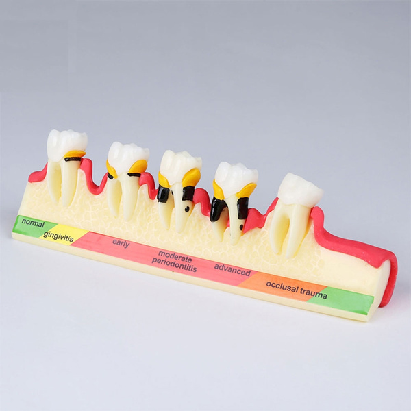Dental Periodontal Disease Classification Model Showing Periodontal ...