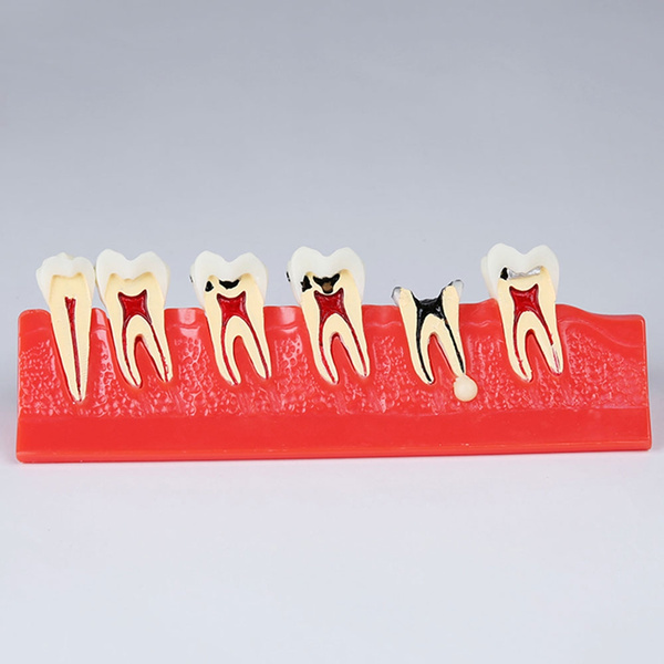 Caries Model Development of Caries and Secondary Caries | Wish