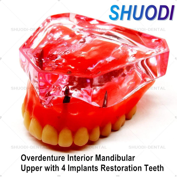 1 piece Dental Overdenture Upper Anterior Maxillary with 4 Implants ...