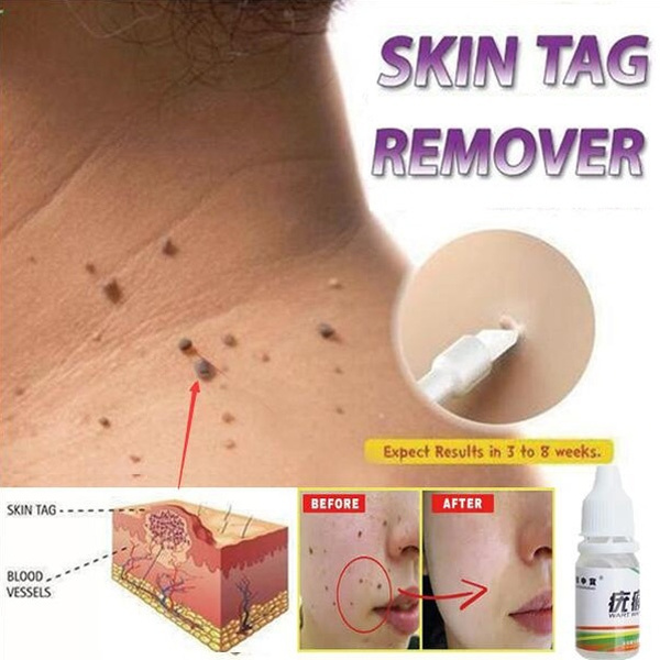 1pcs/2pcs Skin Tag Remover 10ml Warts Treatment Foot Corn Remover ...