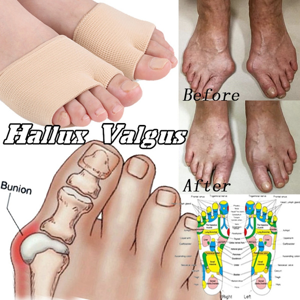 1Pair Bunion Corrector Silicone Hallux Valgus Braces Big Toe Orthopedic ...