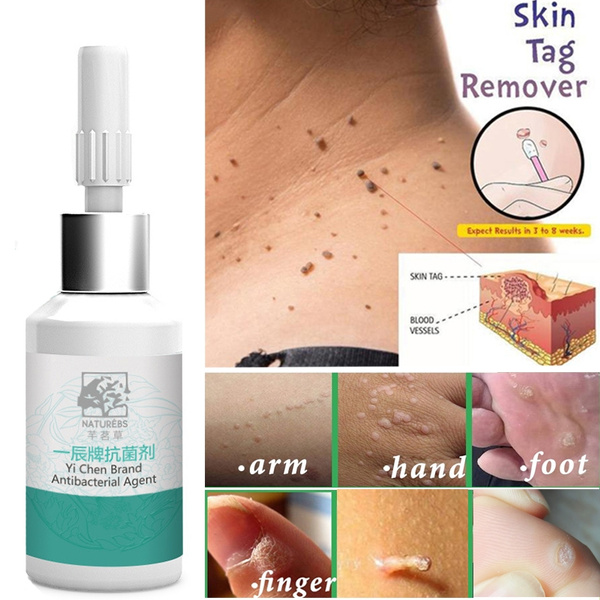Skin Tag Remover Natural Health Mole Nevus Wart Skin Tag Removal Foot ...