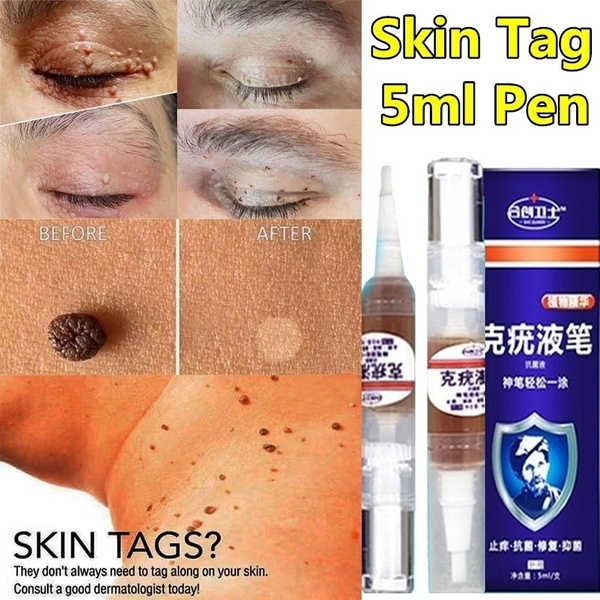 1 Piece 5ml Foot Corn Foot Cocoon Pen Skin Tag Remover 12 Hours Remover ...