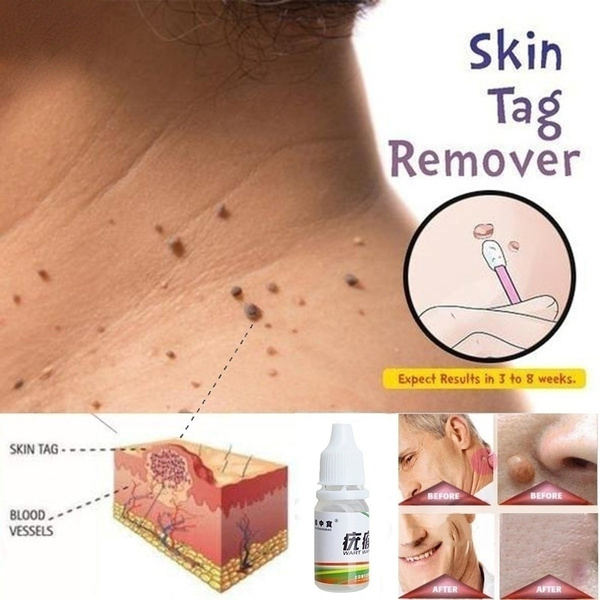 Health Care Skin Tag Removal Warts Treatment Foot Corn Removal Plantar ...