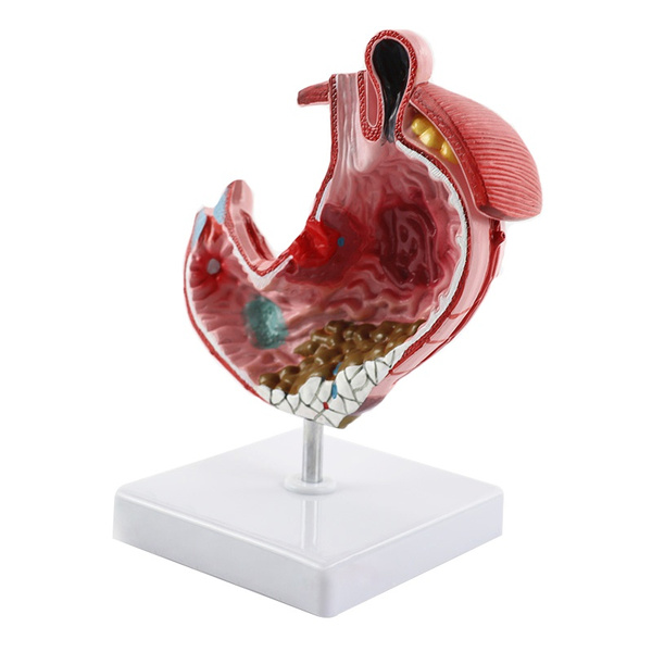 Human Gastric Anatomy, Medical, Gastrointestinal and Pathology ...