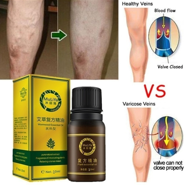 30ml Varicose Vein Oil Therapy Lymphatic Drainage Oil Vasculitis ...