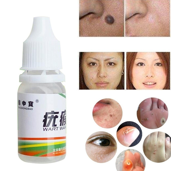 Skin Tag Removal Warts Treatment Foot Corn Removal Plantar Warts Pomada ...