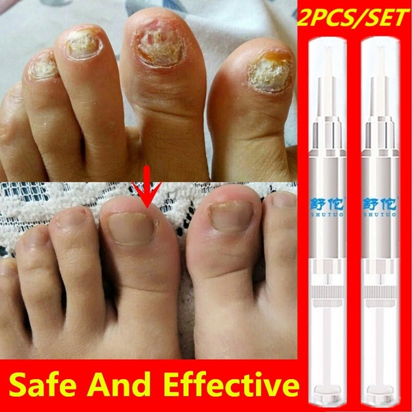 Newest 3ML Anti Fungal Nail Treatment Nail Pen Onychomycosis Paronychia ...