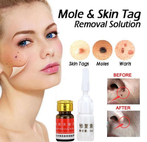 Mole & Skin Tag Removal Solution 100% remover skin tags & warts & Moles ...