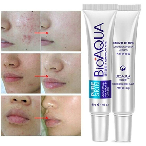 BIOAQUA Face Acne Treatment Cream Anti Acne Scars Removal Gel Stretch ...