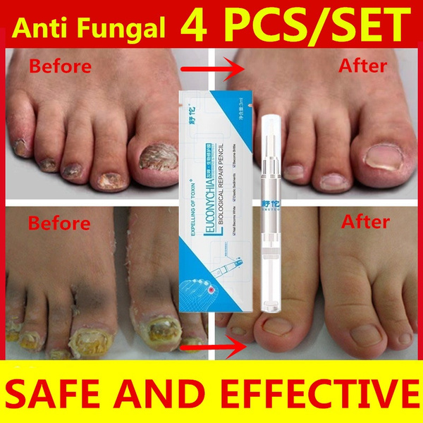 Newest 3ML Anti Fungal Nail Treatment Nail Pen Onychomycosis Paronychia ...