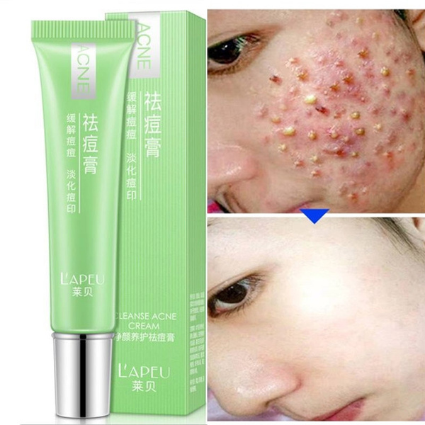 Pro Women Acne Removal Cream Hydrating Anti Acne Oil Control Fade Acne ...