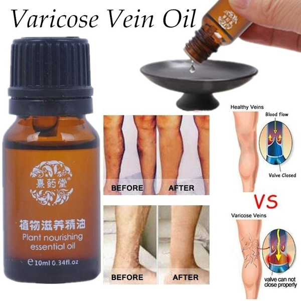 Hot 1 Piece Varicose Vein Oil Therapy Lymphatic Drainage Essential Oil ...