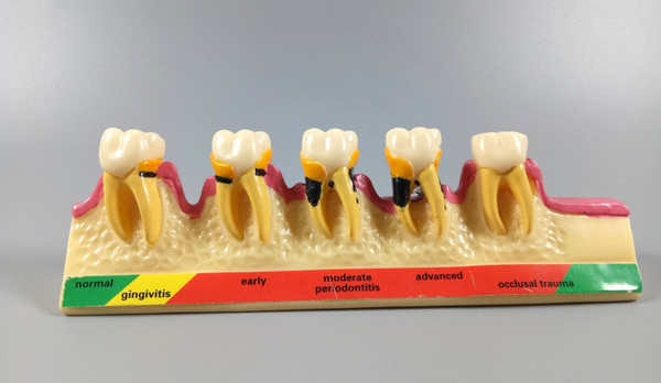 Dental Study Teaching Model Periodontal Disease Assort Teeth Dentoform ...