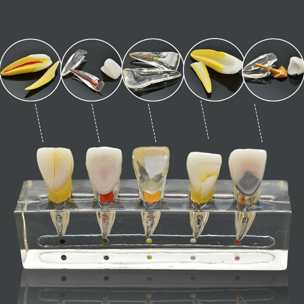 Dental Endodontic Pathology Study Model Demonstration Treatment ...