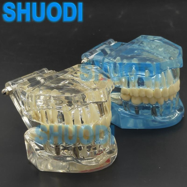 1 piece or 2 pieces Dental Implant Disease Teeth Model With Restoration ...