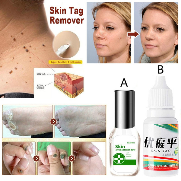 HOT SALE!Skin Tag Remover Warts Treatment Foot Corn Remover Plantar ...