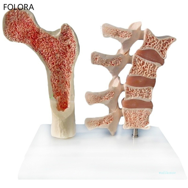 Human Lumbar Vertebral Thigh Bone Osteoporosis Model Deluxe Traumatic ...