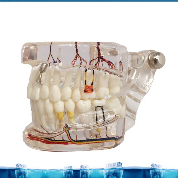 Dental Implant Teeth Model with Nerve Transparent Pathological Repair ...