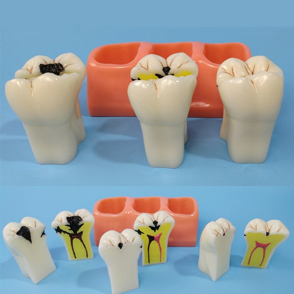 4 Times Caries Disassembling Model Denture Disease Teeth Model for ...