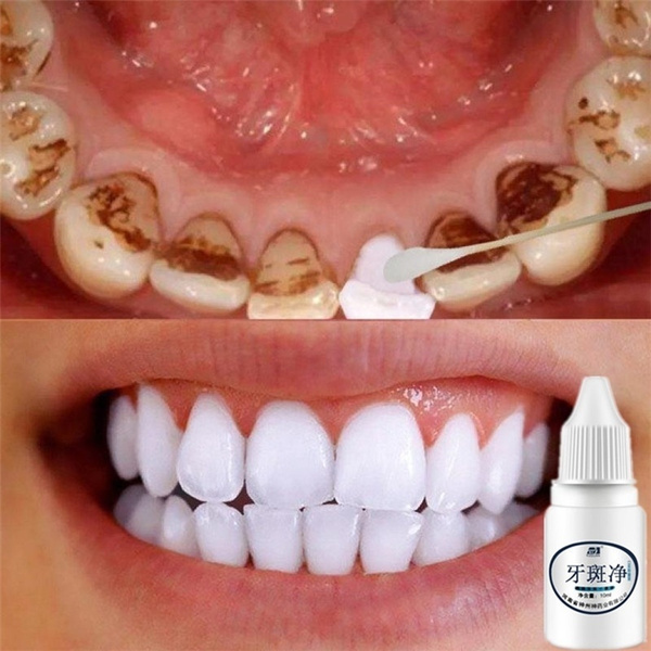 1 Bottle 10ML Teeth Whitening Oral Hygiene Cleaning Oral Teeth Care ...