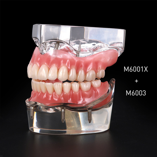 2PCS New Dental Teeth Study Model Overdenture Inferior 4 Implant Demo ...