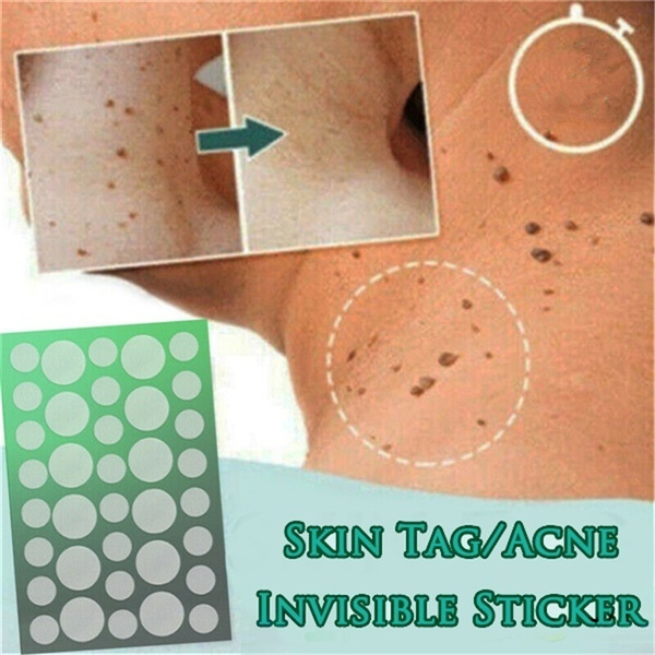 36pcs/sheet Fibroepithelial Polyp Removal Patch Effectively Remove Skin ...