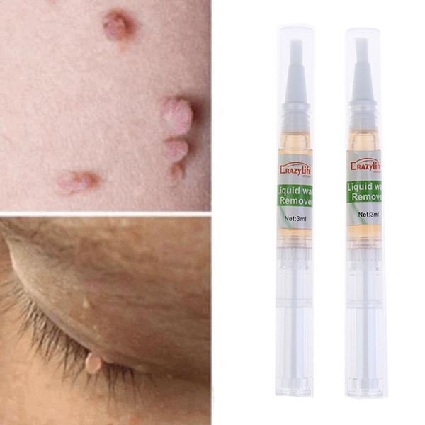 5 Days Skin Tag Remover Pen Natural Health Mole Nevus Wart Skin Tag ...