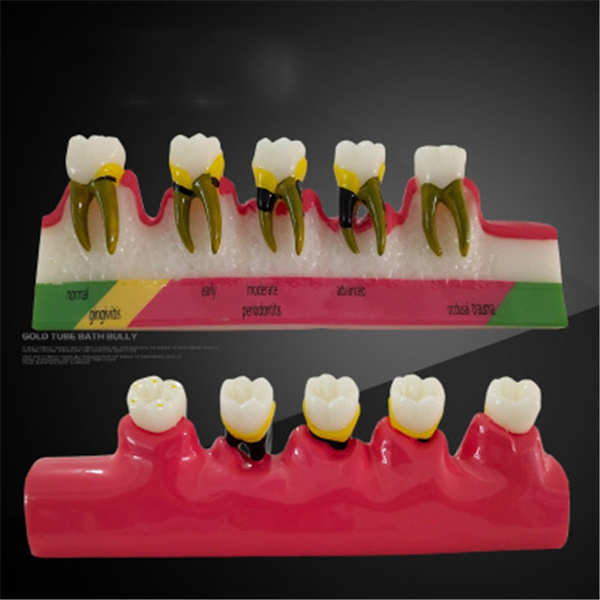 Dental Periodontal disease Model caries classify model for ...