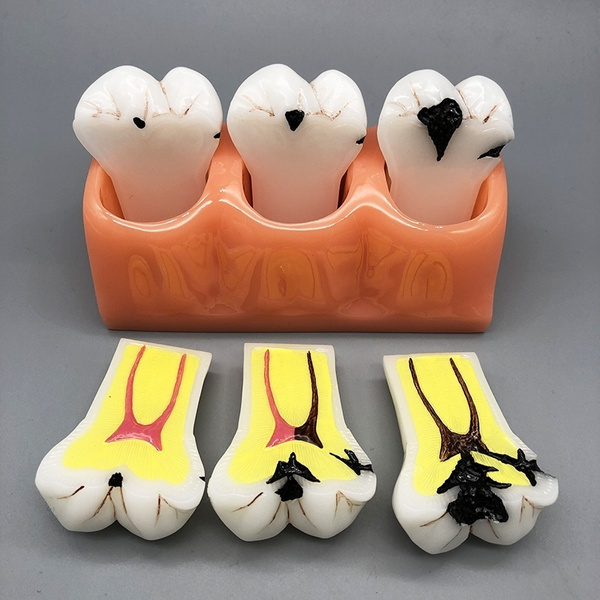 Dentist Dental Teeth Model Patient Education Caries Endodontic ...