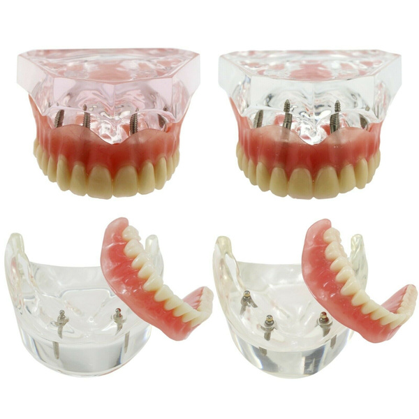 1pc Dental Implant Typodont Model Overdenture Restoration Teeth Demo ...