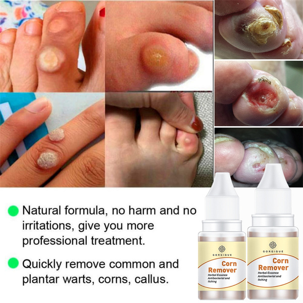 10/20/30/50ml Skin Tag Remover Liquid Foot Corn Plantar Body Warts ...