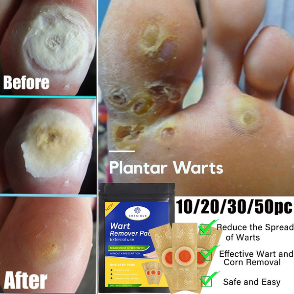 10/20/30/50pc Medical Plaster Foot Corn Callus Removal Thorn Plantar ...