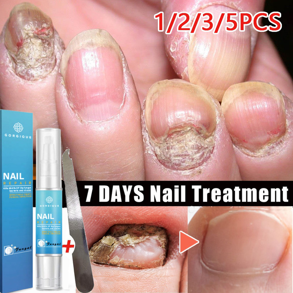 NEW 3ML Anti Fungal Treatment Nail Pen Onychomycosis Paronychia ...
