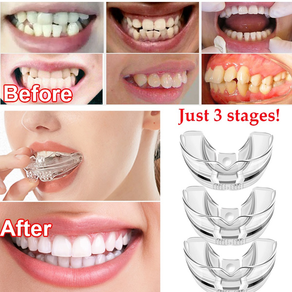 3 Stages Adults Orthodontic Trainer Dental Tooth Appliance Alignment ...