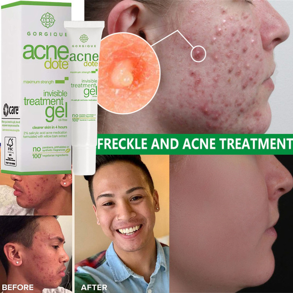 10g/20g/30g/50g 2021 Newest Acne Spot Treatment Acne Dark Spot Removal ...