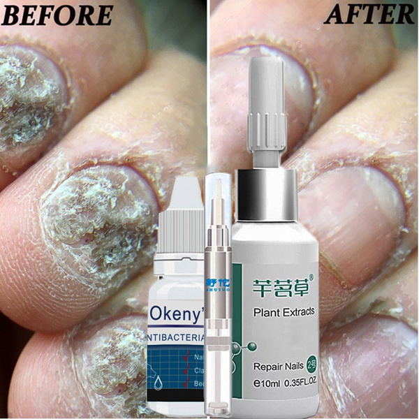 New special effect, foot care can remove finger and toe nail fungus ...