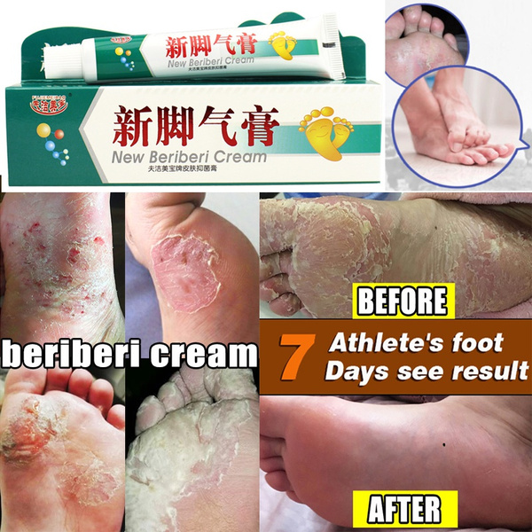 1/2pcs Anti Fungal Infections Foot Cream Treatment Athlete Foot Pain ...