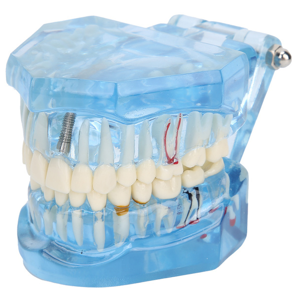 Dental Teeth Model Acrylic Blue Transparent Teaching Demonstration ...