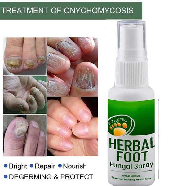 1 Pcs Foot Antibacterial Spray Foot Onychomycosis Odor Exfoliating ...