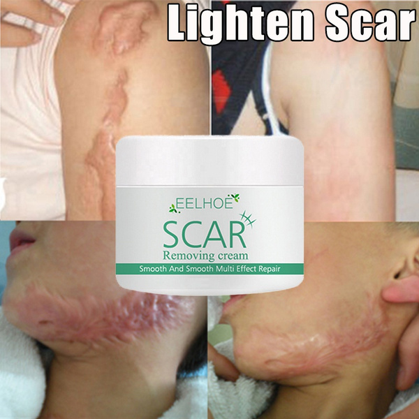 Scar Cream Skin Repair Acne Treatment Smooth Removal of Melanin ...