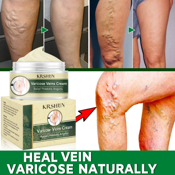 10g/20g/30g/50g 2021 Latest Varicose Vein Ointment Vascular Pain ...