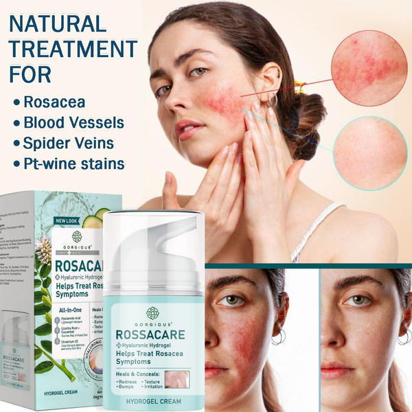 10g/20g/30g/50g Rosacare Gel Medicated Skincare Treats Redness ...