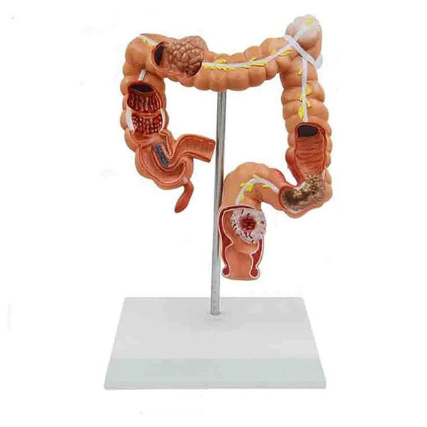 Human Large Intestine Anatomical Model Visceral Lesion Model - Colon ...